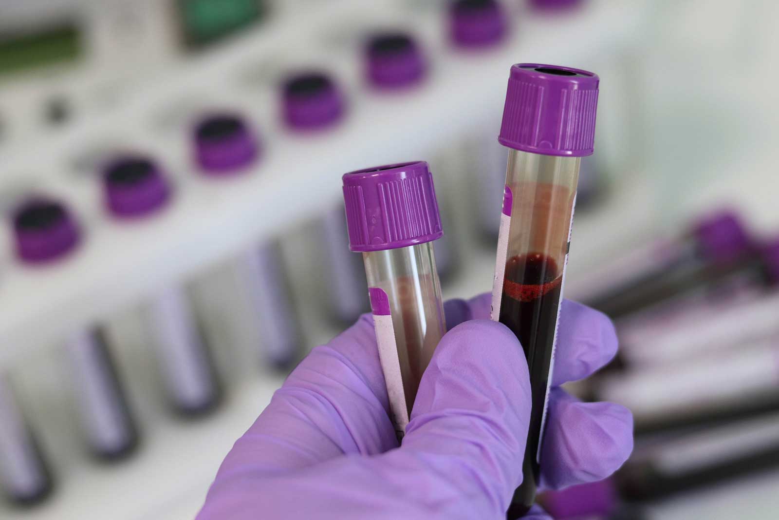 What Is The HbA1c Test And Why Should One Get It Ecotown what-is-the-hba1c-test-and-why-should-one-get-it-ecotown